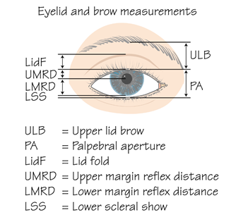 · Bilateral or unilateral ptosis
